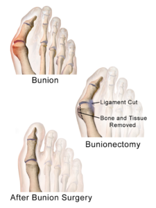 Bunions Treatment / Surgery - Westchester Bunion Surgery